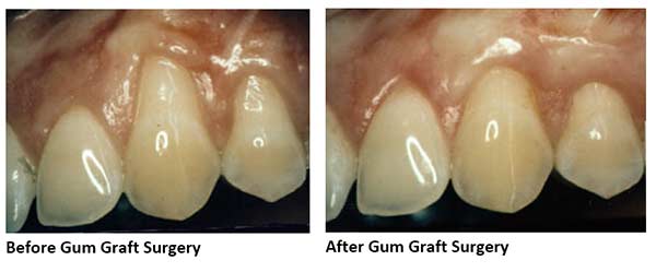 Gum Grafting Surgery | Vijovis Eye & Dental Care Centre